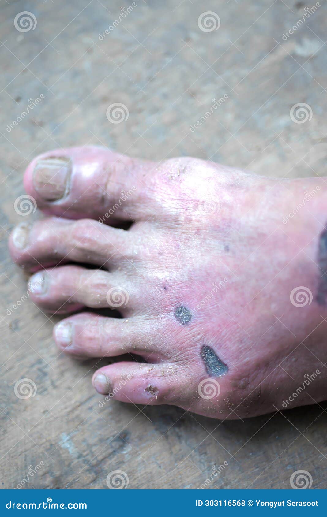 Bump Blemishes,scars on the Skin Stock Photo - Image of ailing ...