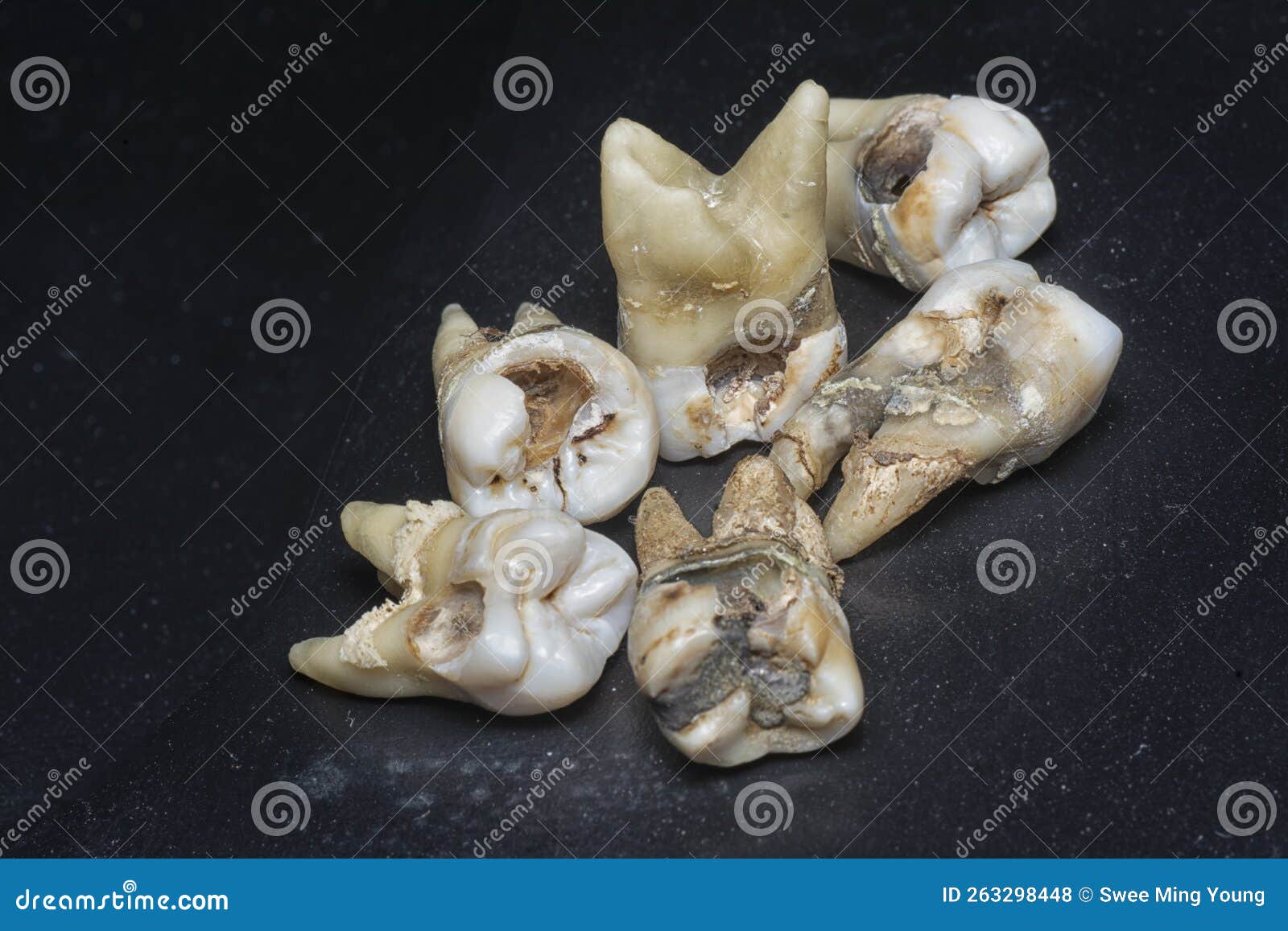 The Bundle of Unwanted Extracted Decay Human Teeth. Stock Photo - Image ...