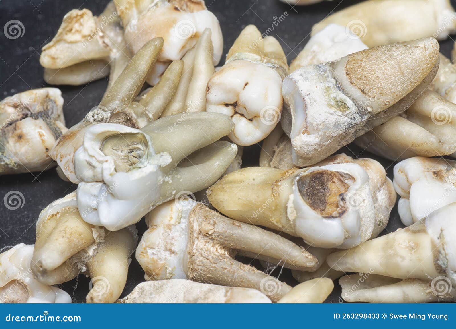 The Bundle of Unwanted Extracted Decay Human Teeth. Stock Image - Image ...