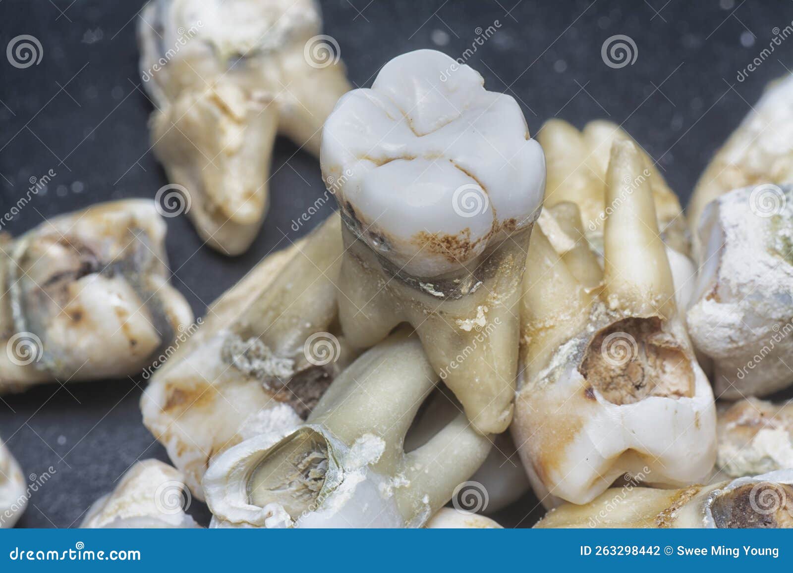 The Bundle of Unwanted Extracted Decay Human Teeth. Stock Photo - Image ...