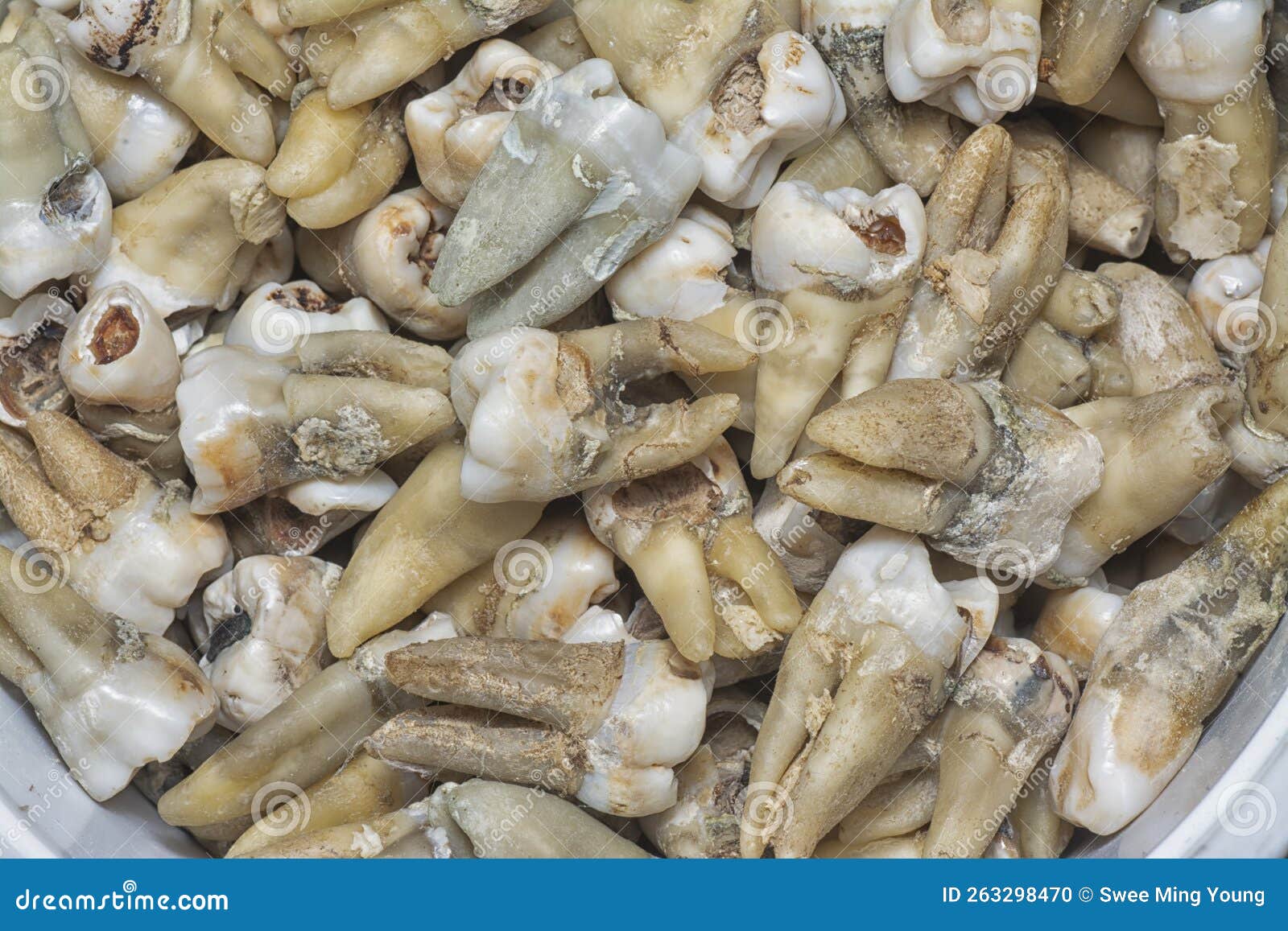 The Bundle of Unwanted Extracted Decay Human Teeth. Stock Photo - Image ...