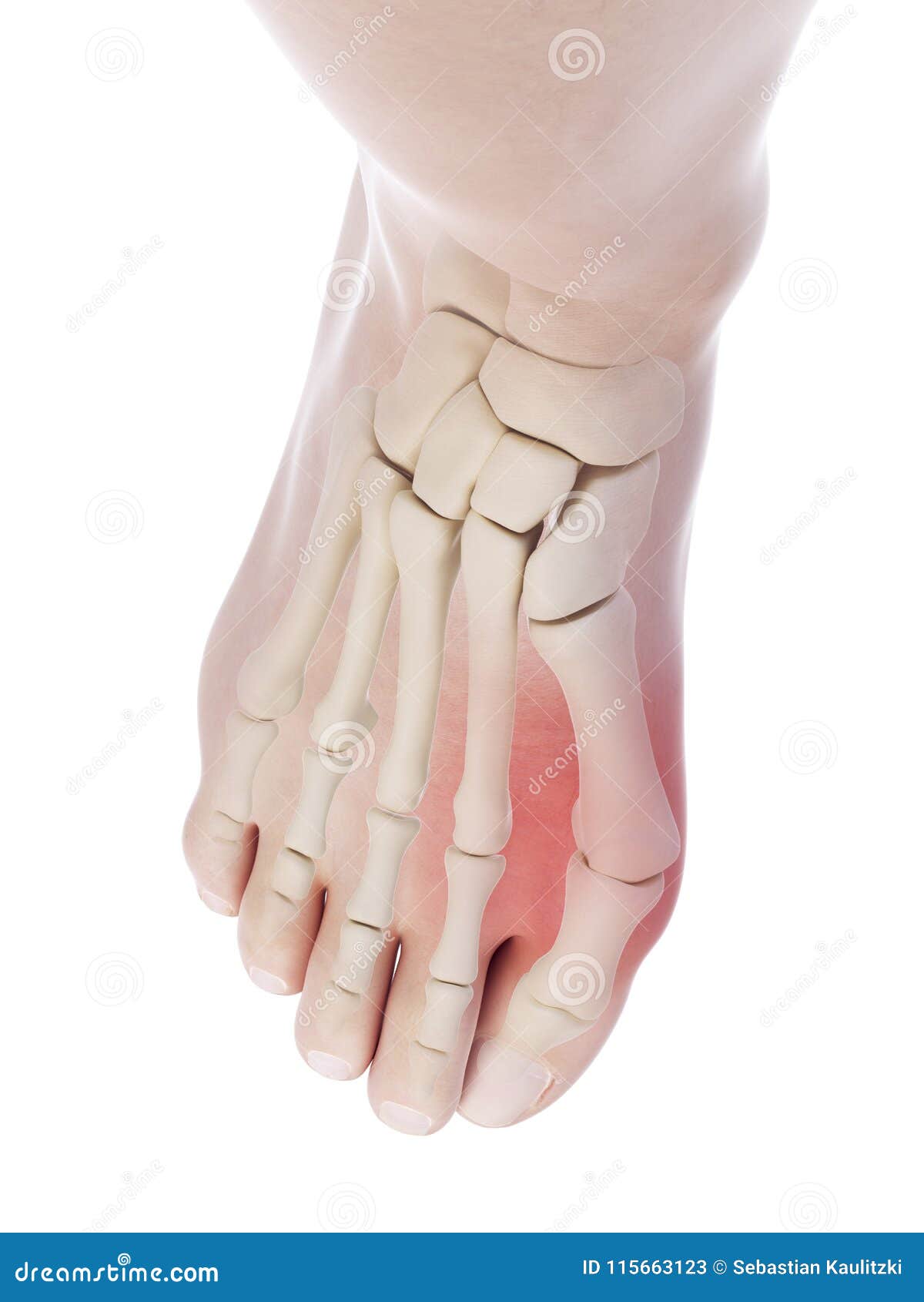 A bunion stock illustration. Illustration of deviation - 115663123