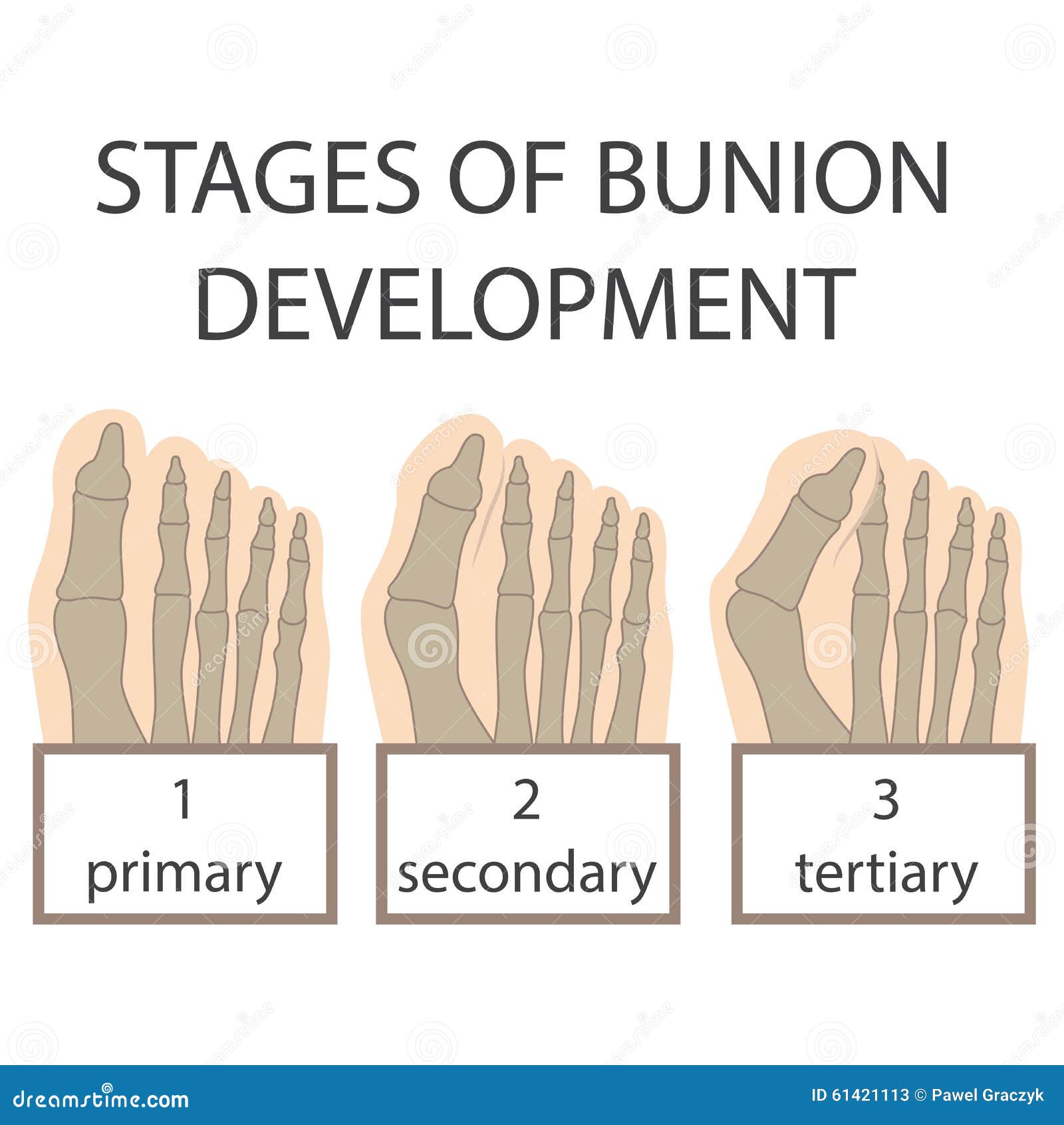 Bunion Cartoons, Illustrations & Vector Stock Images - 375 Pictures to ...