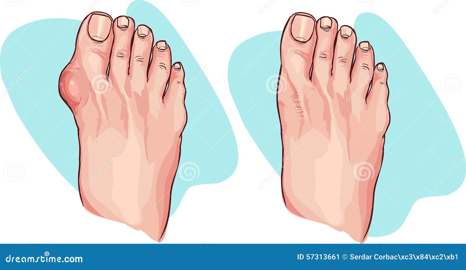 Bunion before and after Operation. Vector Illustration Stock Vector ...