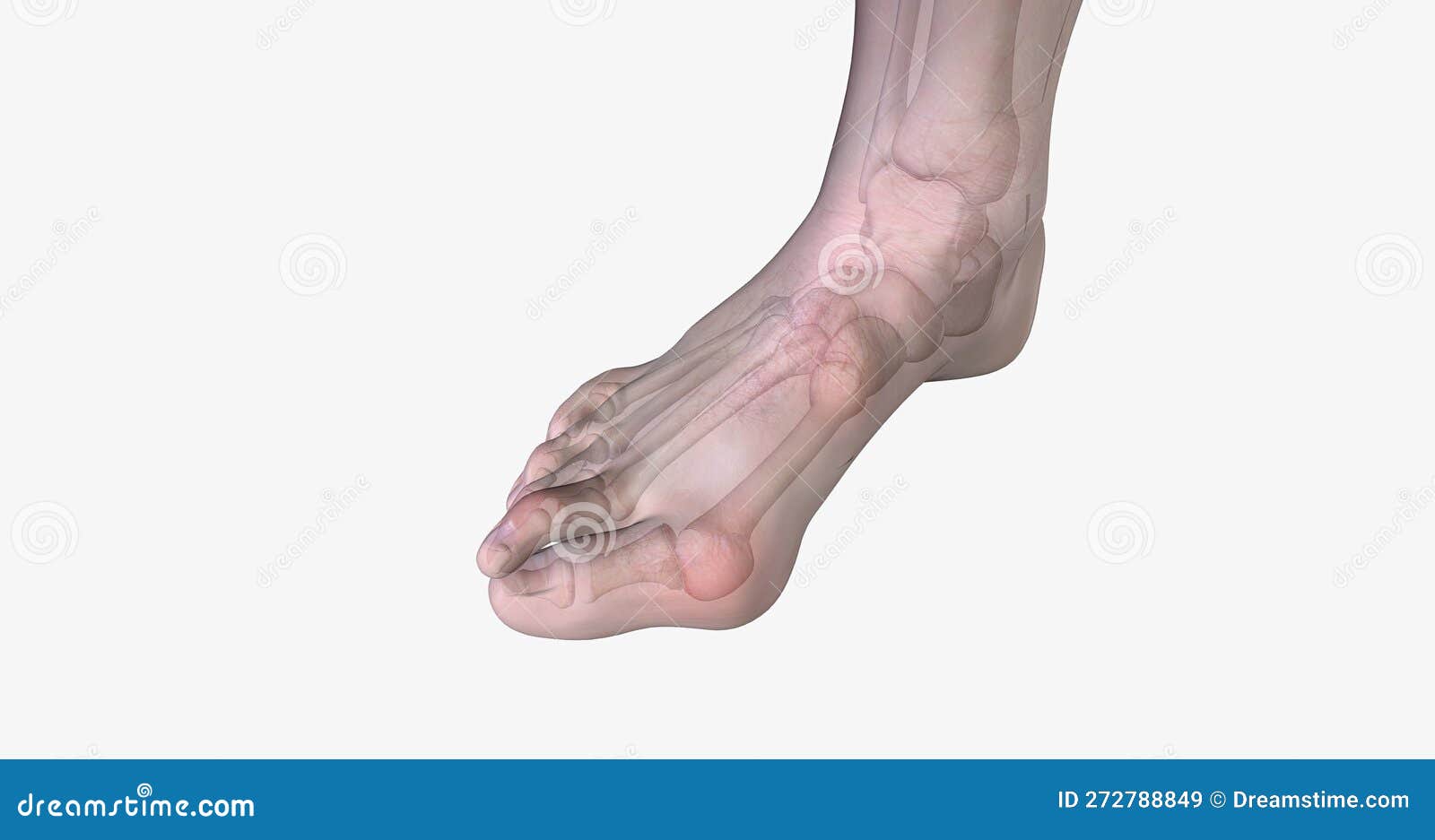 The Bunions and Overlapping Toes Stock Illustration - Illustration of ...