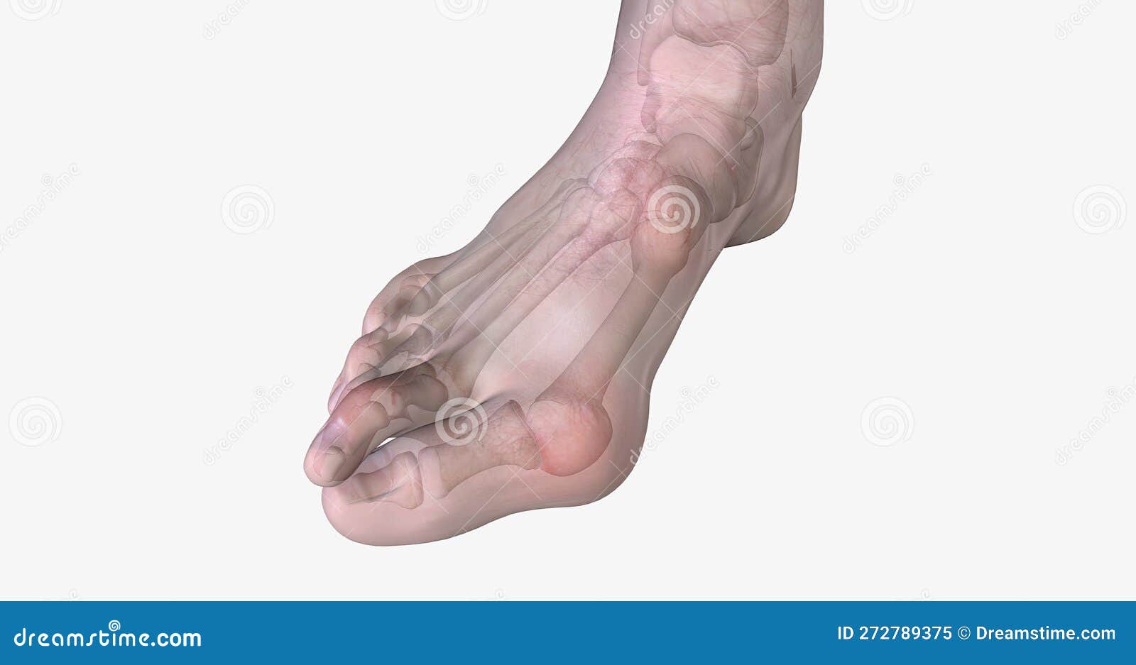 The Bunions and Overlapping Toes Stock Illustration - Illustration of ...