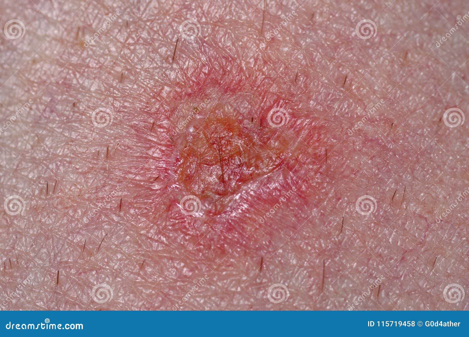 Burn close-up stock photo. Image of dermis, close, injury - 115719458