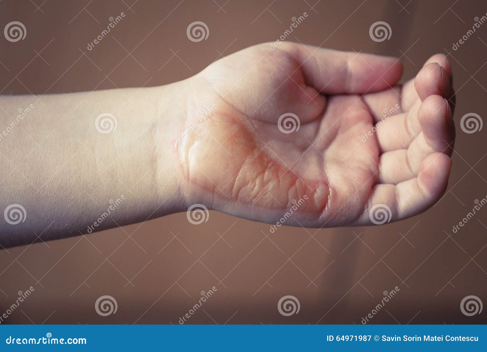 Burn injury stock image. Image of body, affliction, children - 64971987