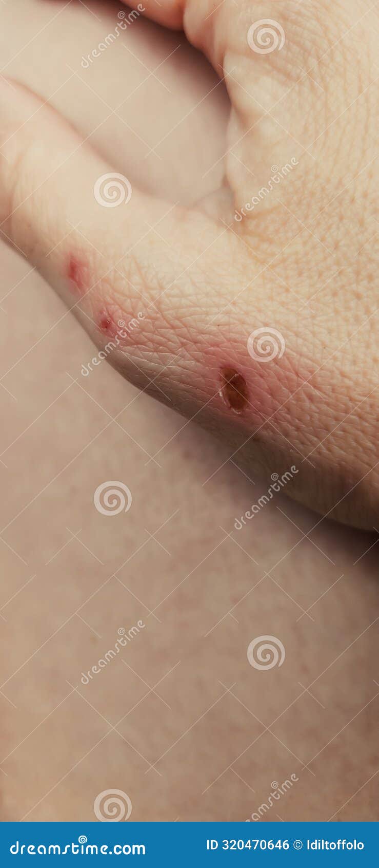Burn Marks on the Skin of Hand Close-up Stock Photo - Image of cure ...