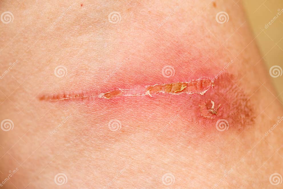 Burn Scar Detail stock photo. Image of painful, flesh - 6112406
