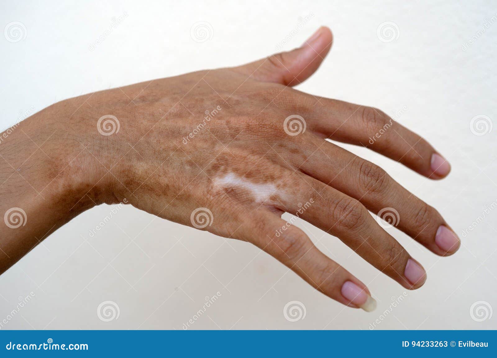 Burn Scar stock image. Image of illness, painful, burnt - 94233263