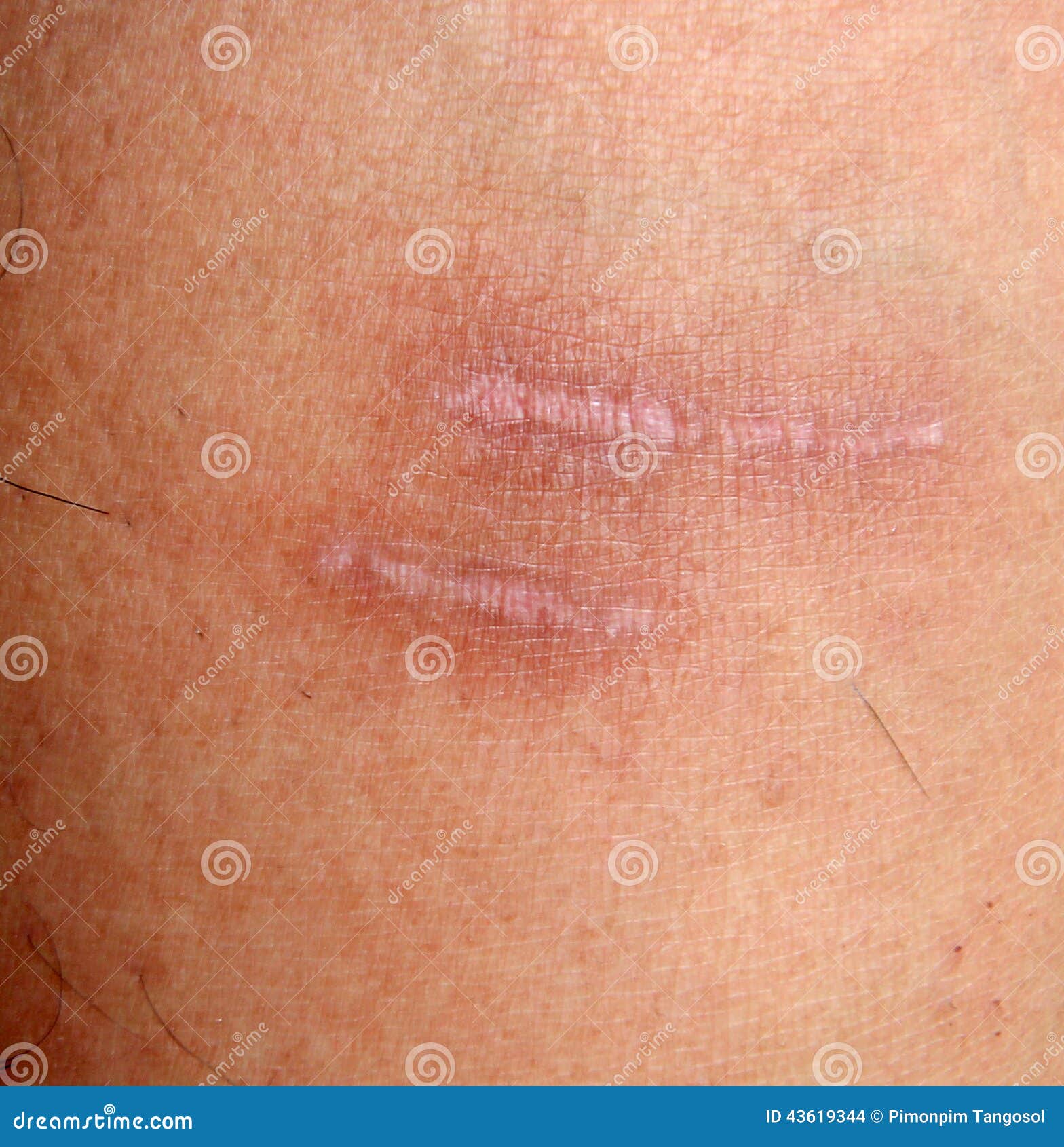 Albums 105+ Pictures Cigarette Burns On Skin Pictures Superb