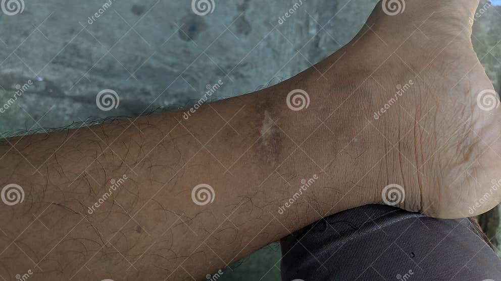 Burn Scars on the Legs that Leave Scars on the Calf Stock Image - Image ...