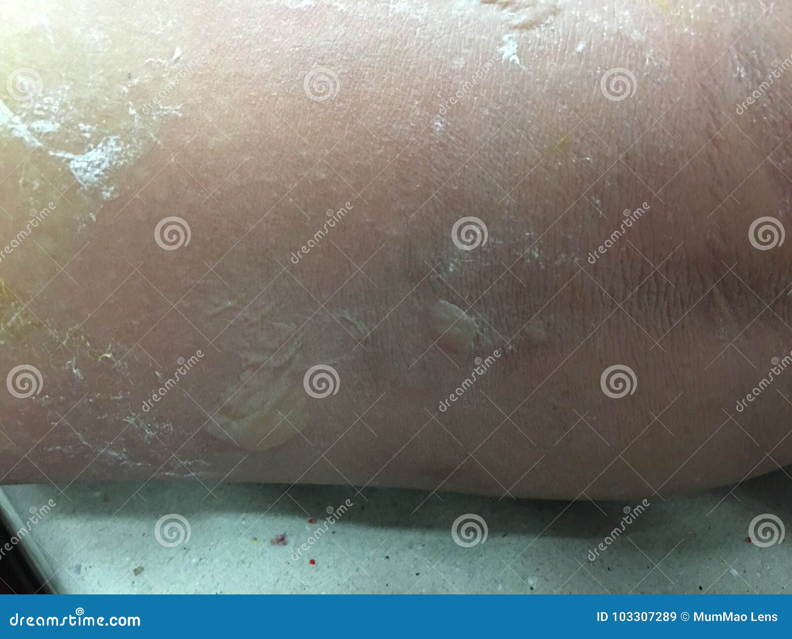 Burn wound stock image. Image of water, medicine, human - 103307289