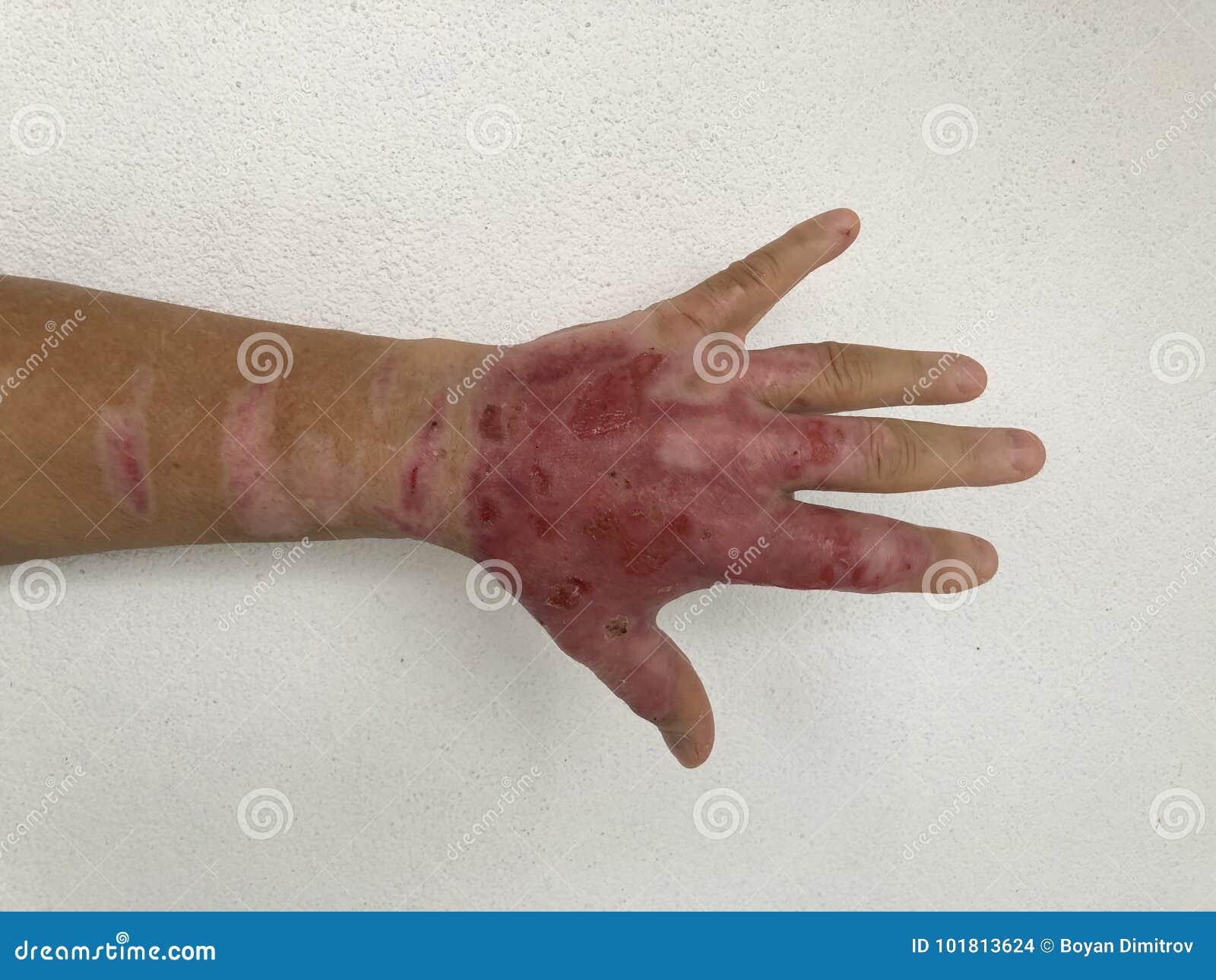 Burned hand stock photo. Image of hand, burnt, damaged - 101813624