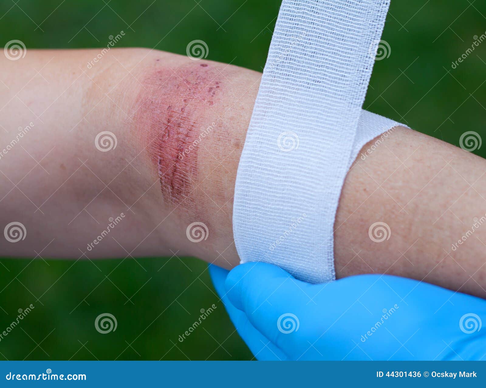 Burned skin stock photo. Image of hurt, injury, accident - 44301436