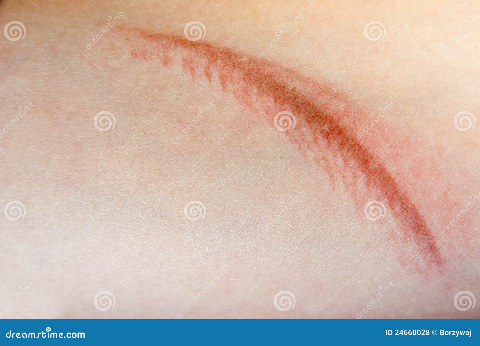 Burned skin scar stock photo. Image of gash, burn, mark - 24660028