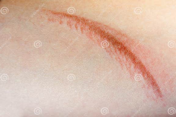 Burned skin scar stock photo. Image of gash, burn, mark - 24660028
