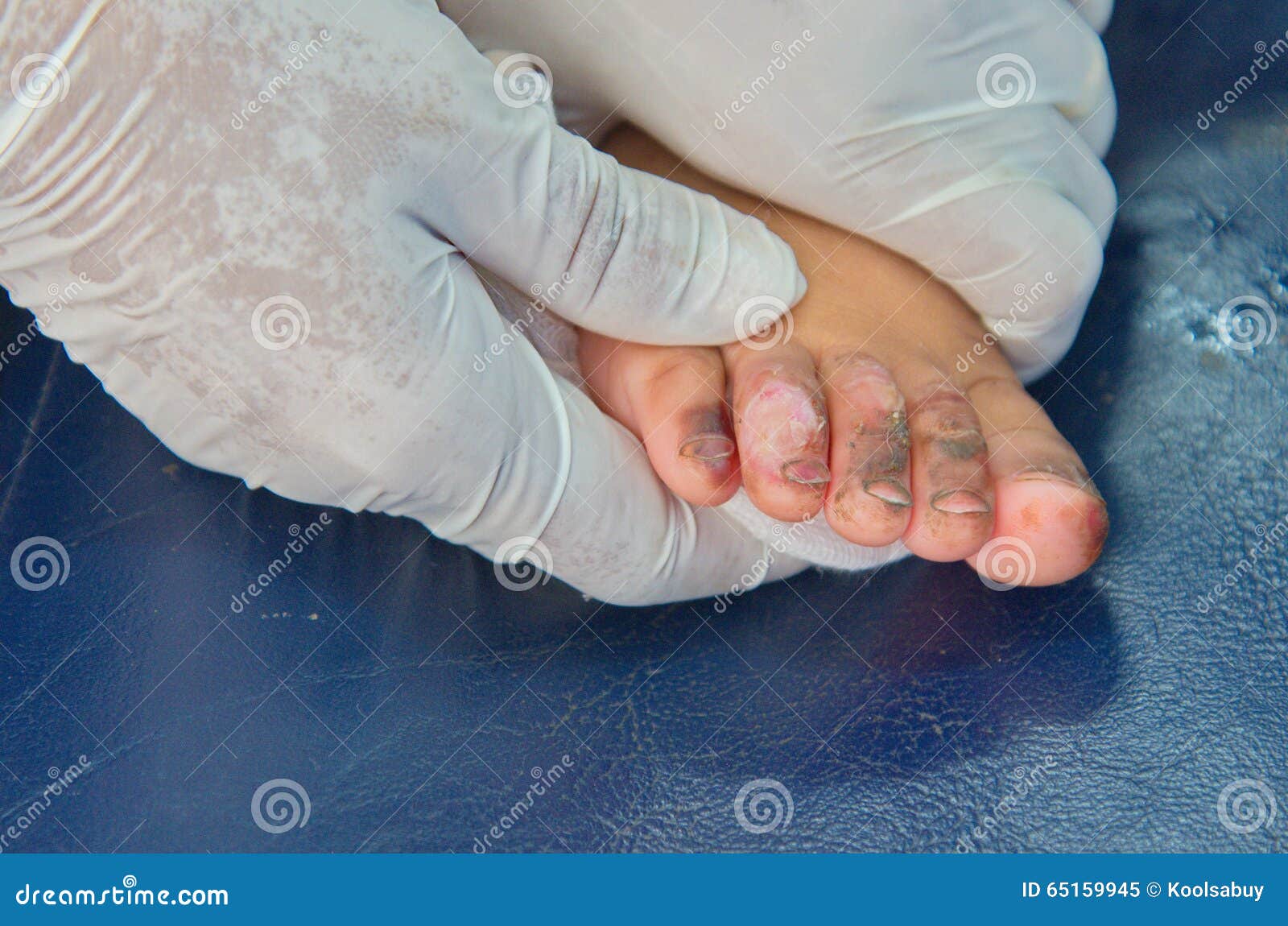 Burned Wound after Cleaning. Stock Image - Image of little, blood: 65159945