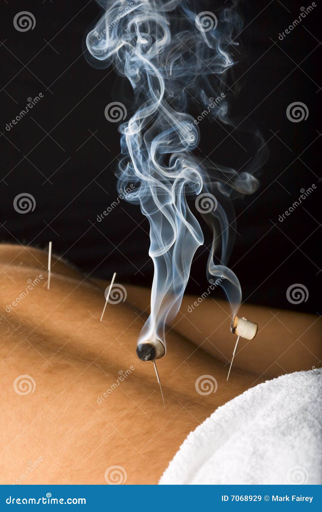 Burning Moxa on Male Patient Stock Image - Image of colour, alternative ...