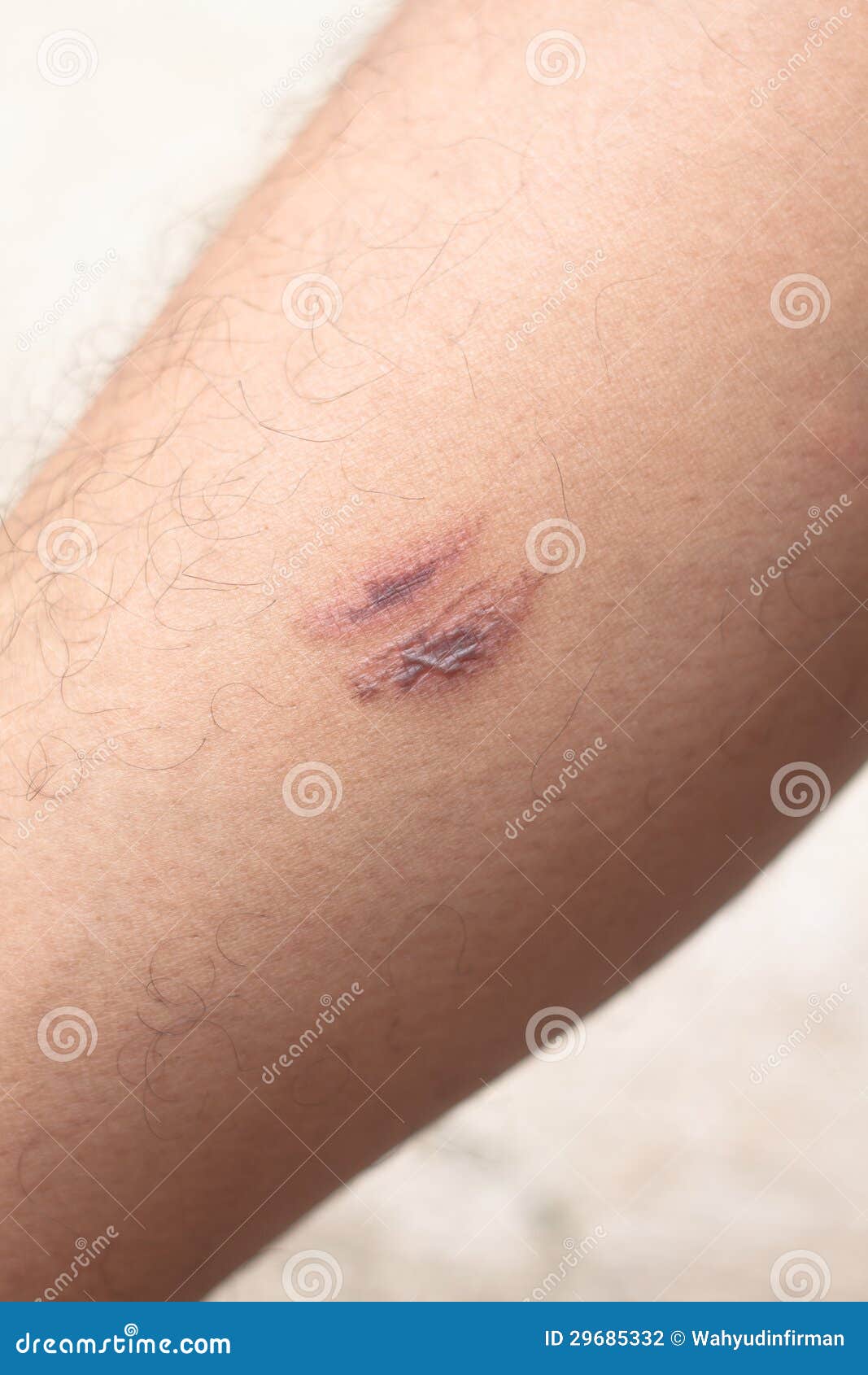 Burning skin stock photo. Image of human, affliction - 29685332