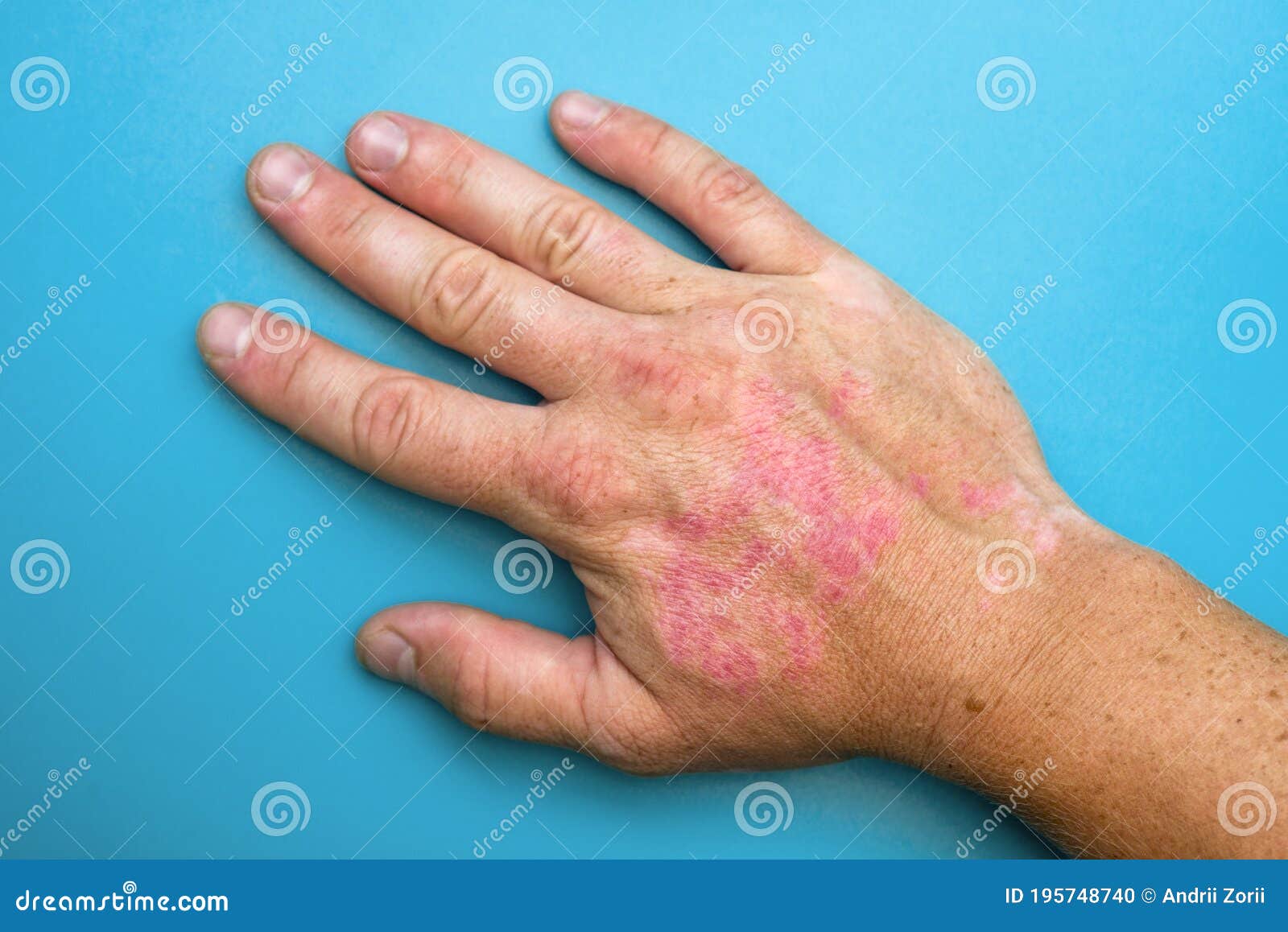 Burns of Hand, Wounds. Hand with Sunburn Stock Photo - Image of painful ...