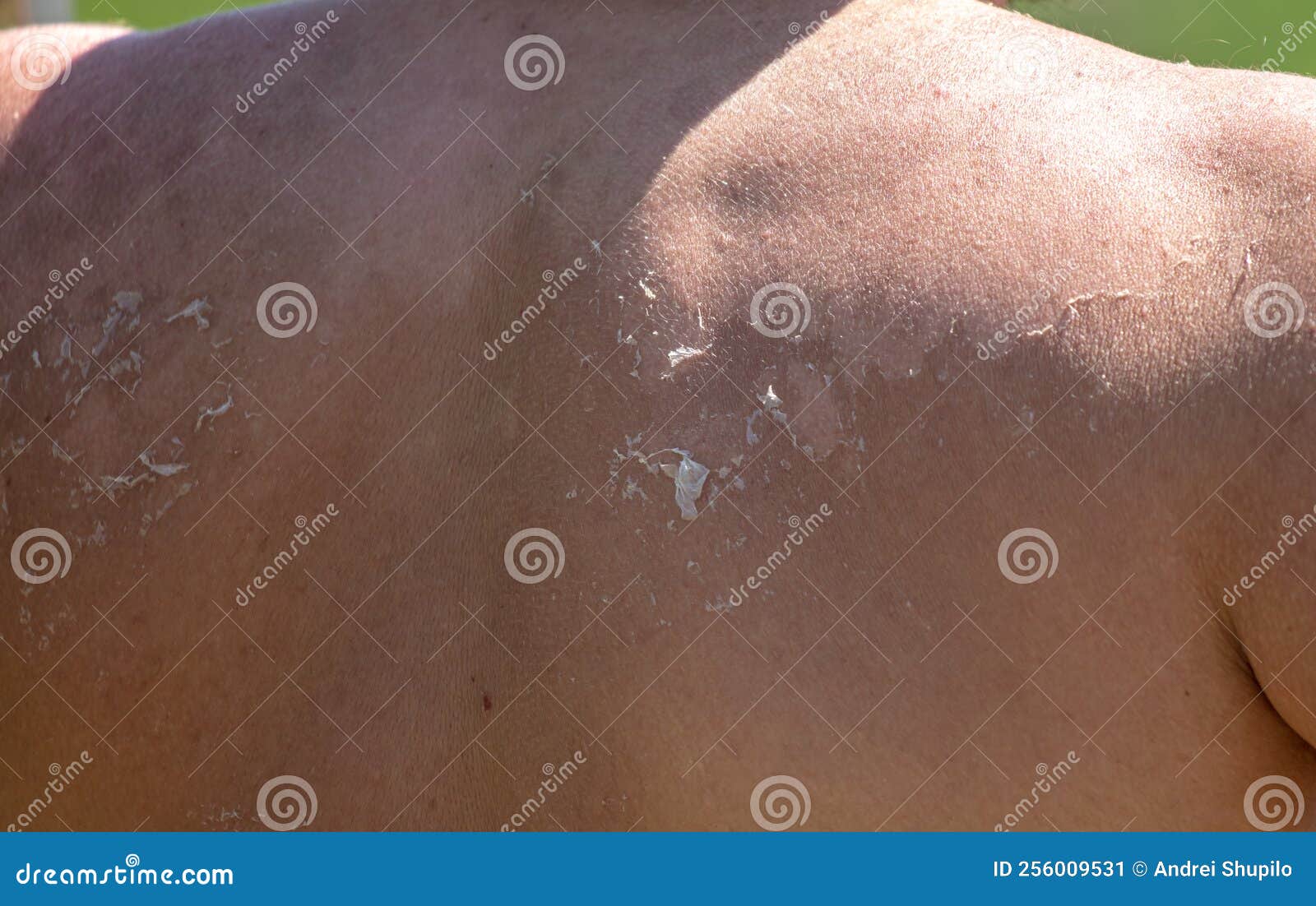 Burnt Skin on the Back of a Man. Stock Image - Image of medical ...