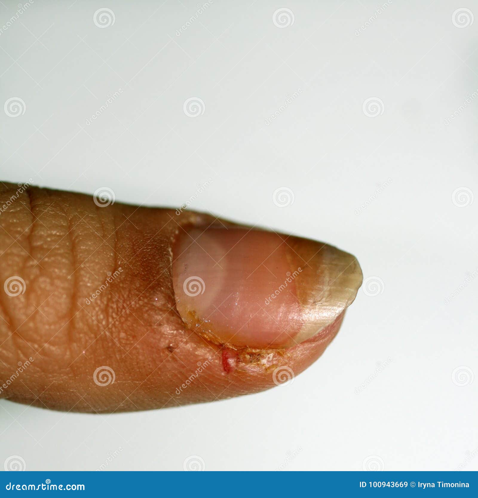 Burrs on the Finger. Inflammation and Abscess. Stock Image - Image of ...