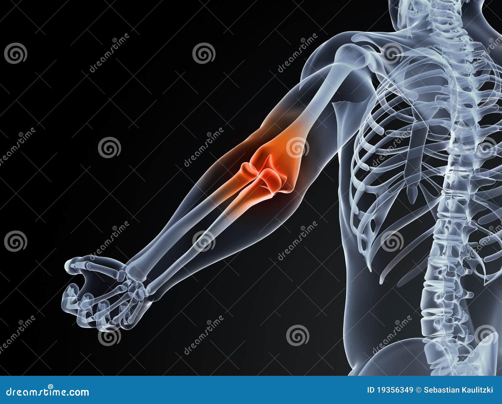 Bursitis del codo stock de ilustración. Ilustración de transparente ...