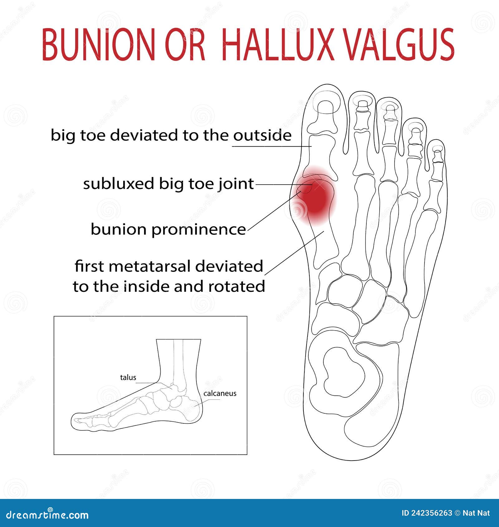 The Bone and Skin on the Sides of the Big Toe Joint Form an Abnormal ...