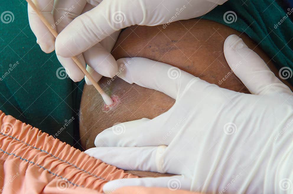 Button abscess draining. stock photo. Image of abscess - 43444610