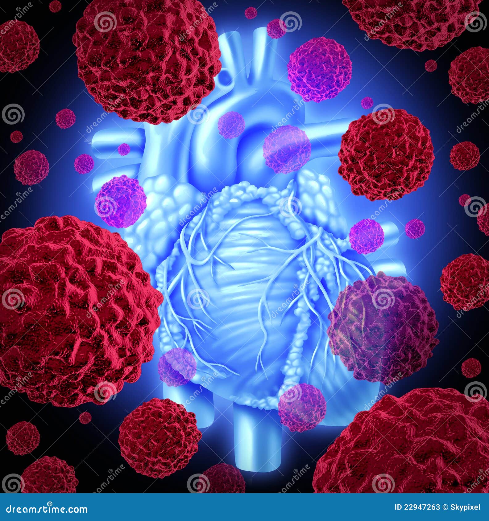 Cáncer humano del corazón stock de ilustración. Ilustración de ...