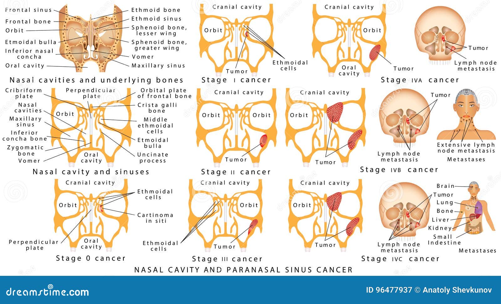 Câncer do nariz ilustração do vetor. Ilustração de câncer - 96477937