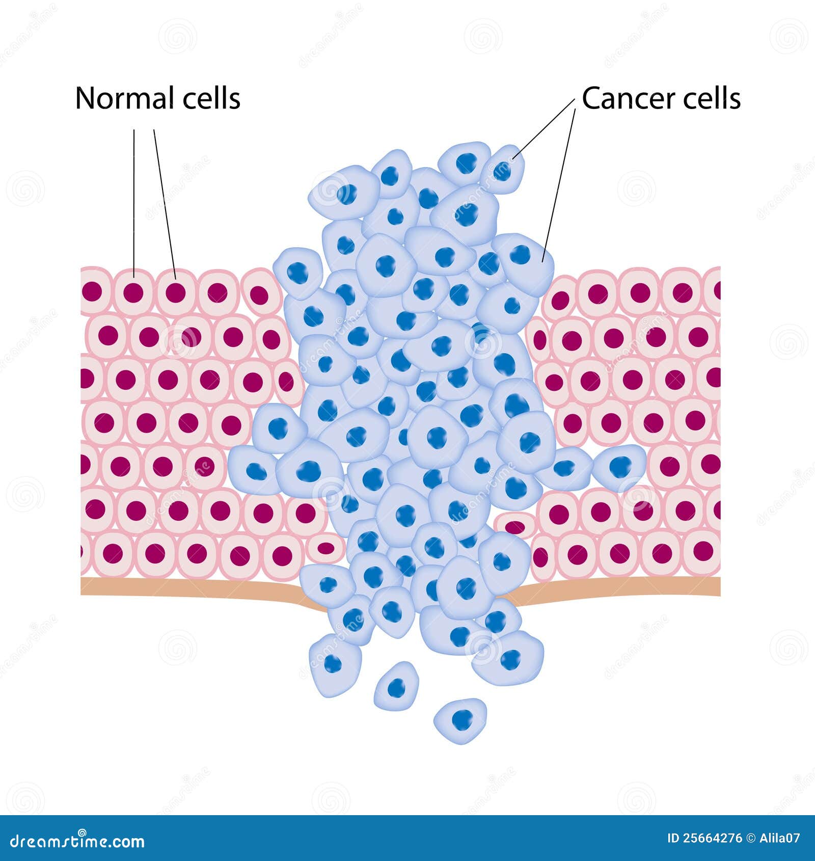 Células cancerosas ilustración del vector. Ilustración de humano - 25664276