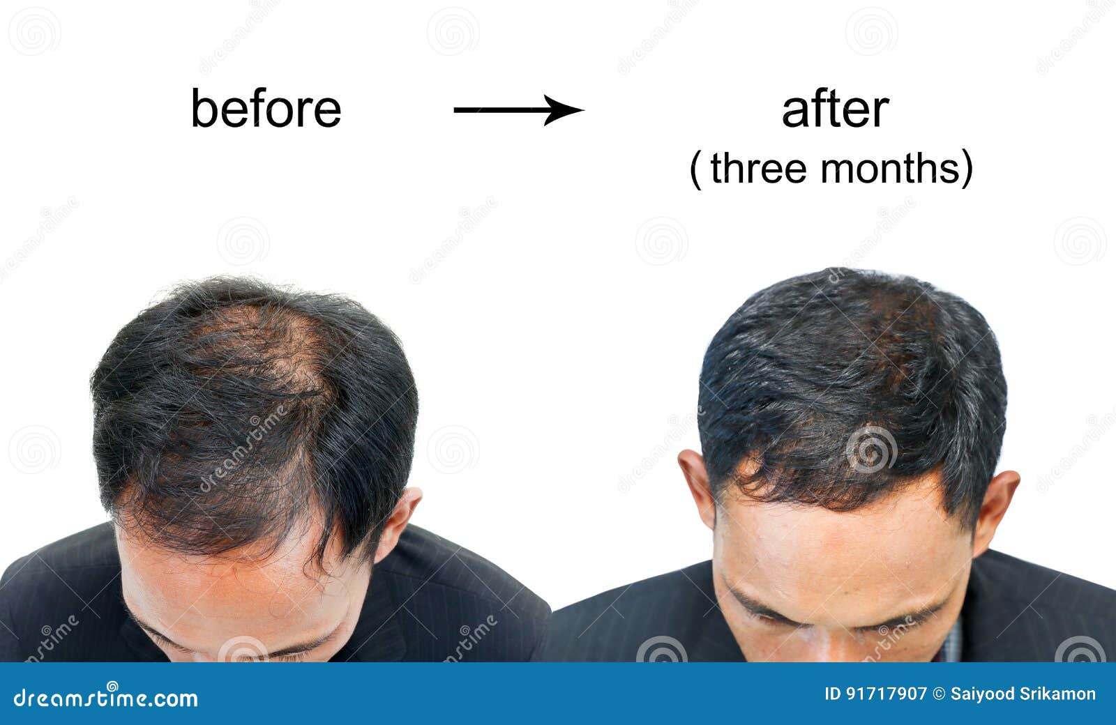 Cabeza calva de un hombre imagen de archivo. Imagen de persona - 91717907