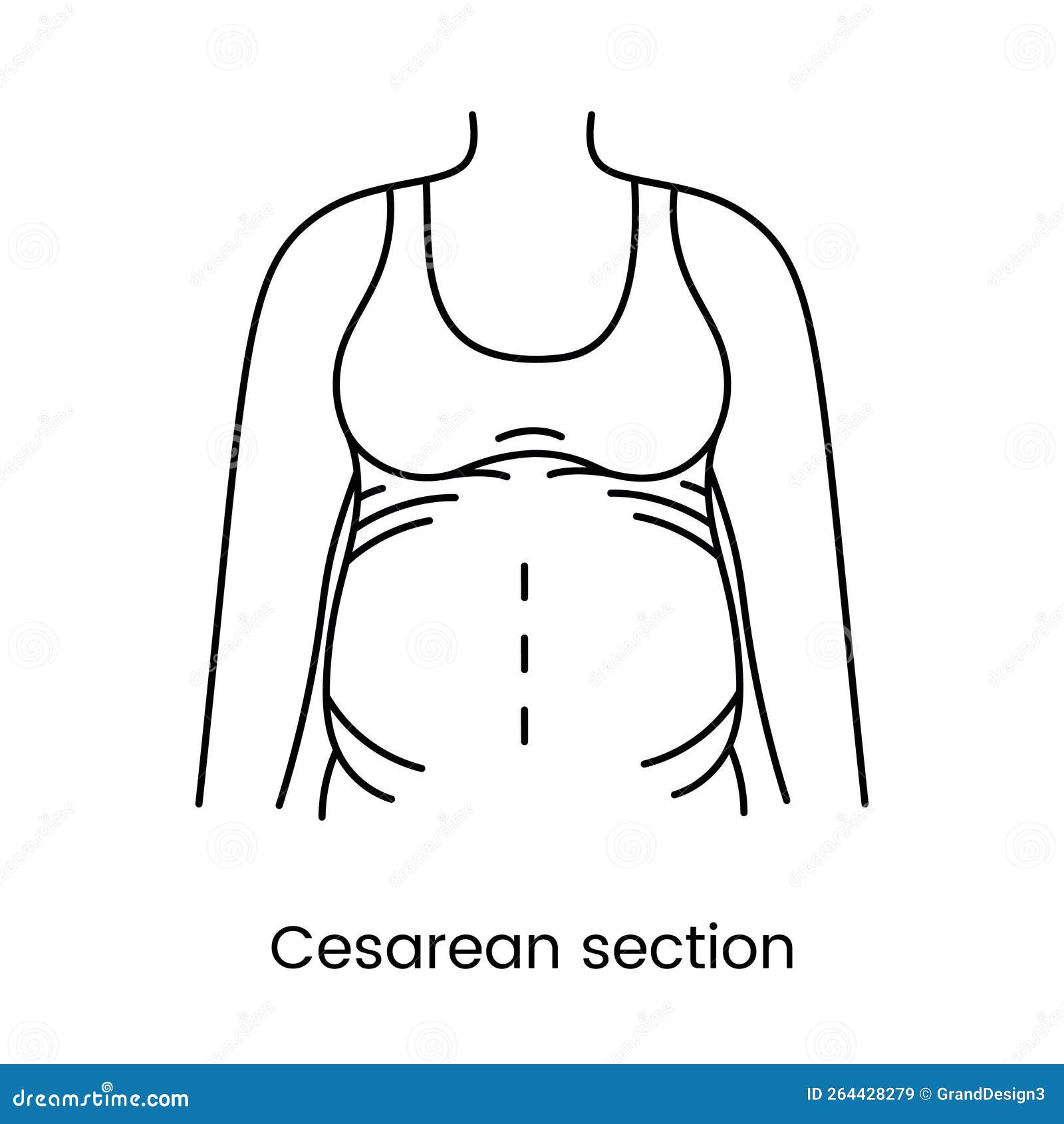 Caesarean Section Scar Low Vertical Incision Classical Incision Low Transverse Incision
