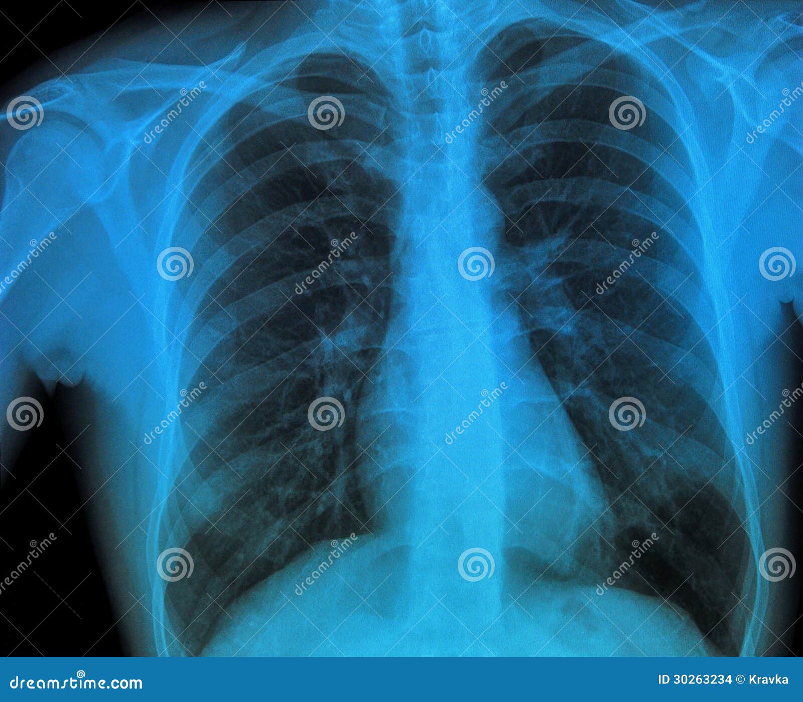 Pulmão do raio X foto de stock. Imagem de exame, normal - 30263234