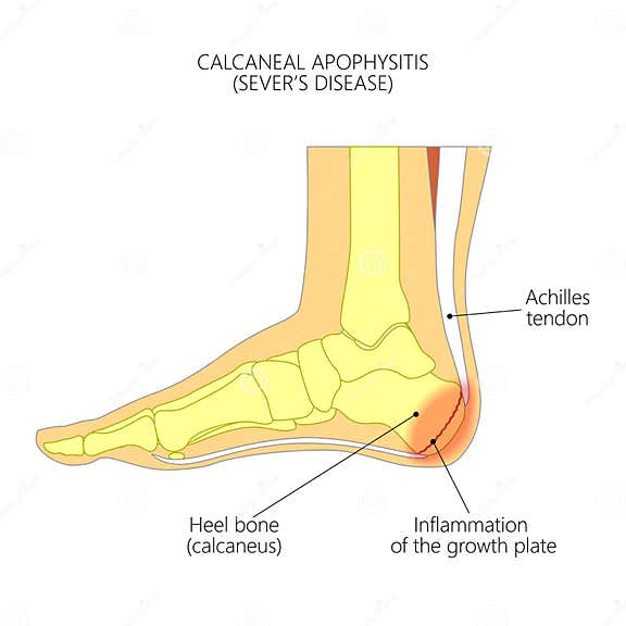 Calcaneal Apophysitis vektor abbildung. Illustration von problem - 75976069
