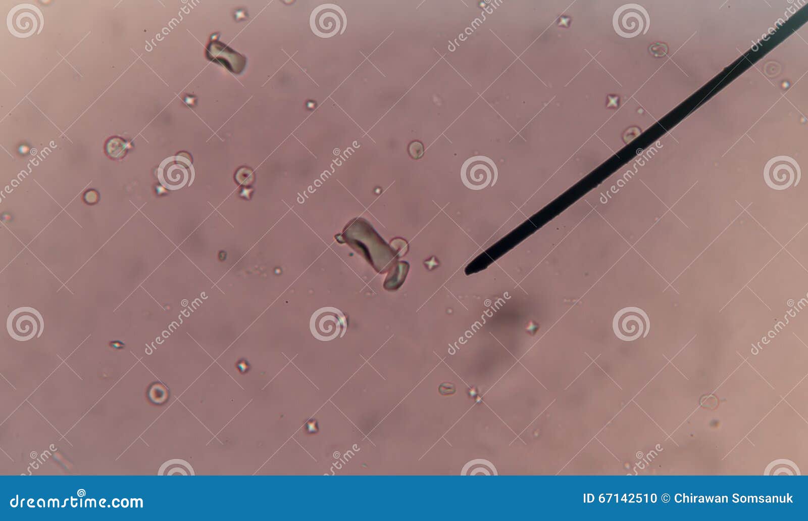 Calcium Oxalate Crystal Urine Stock Images - 28 Photos