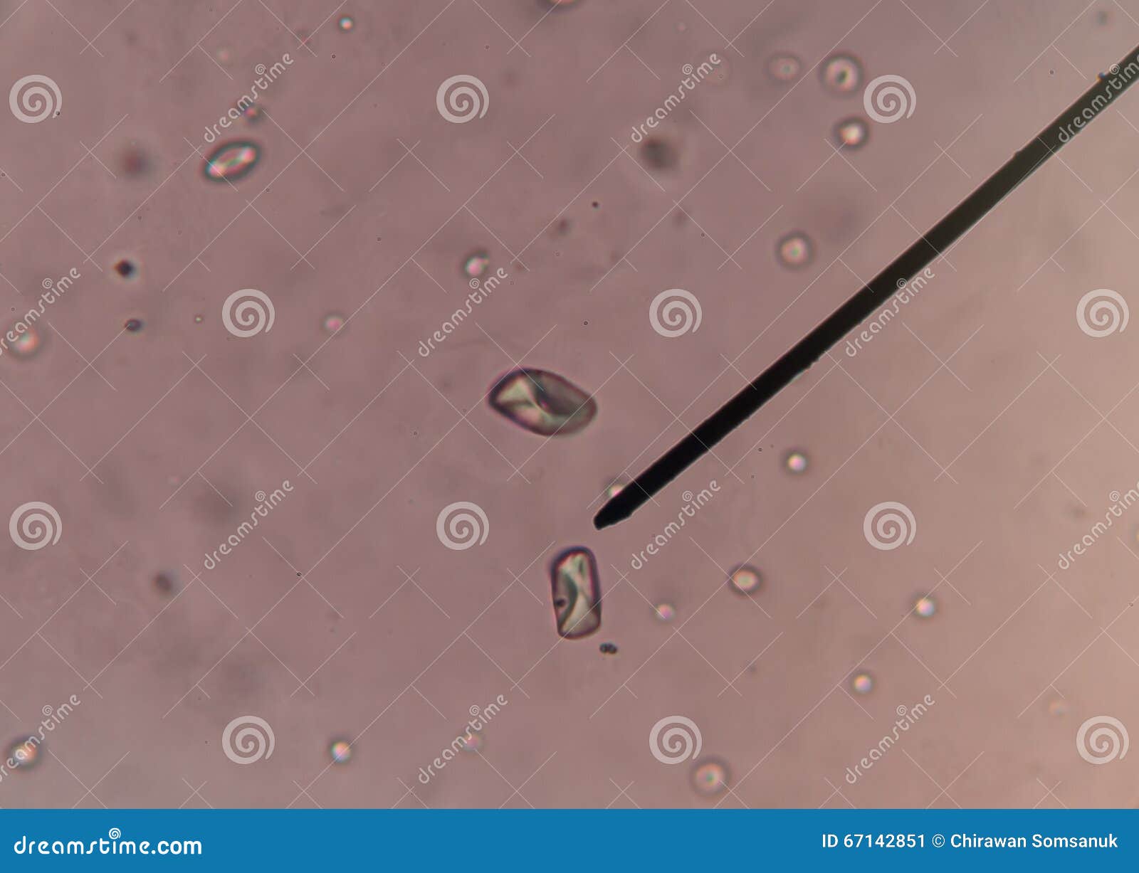 Calcium Oxalate Stone Microscope