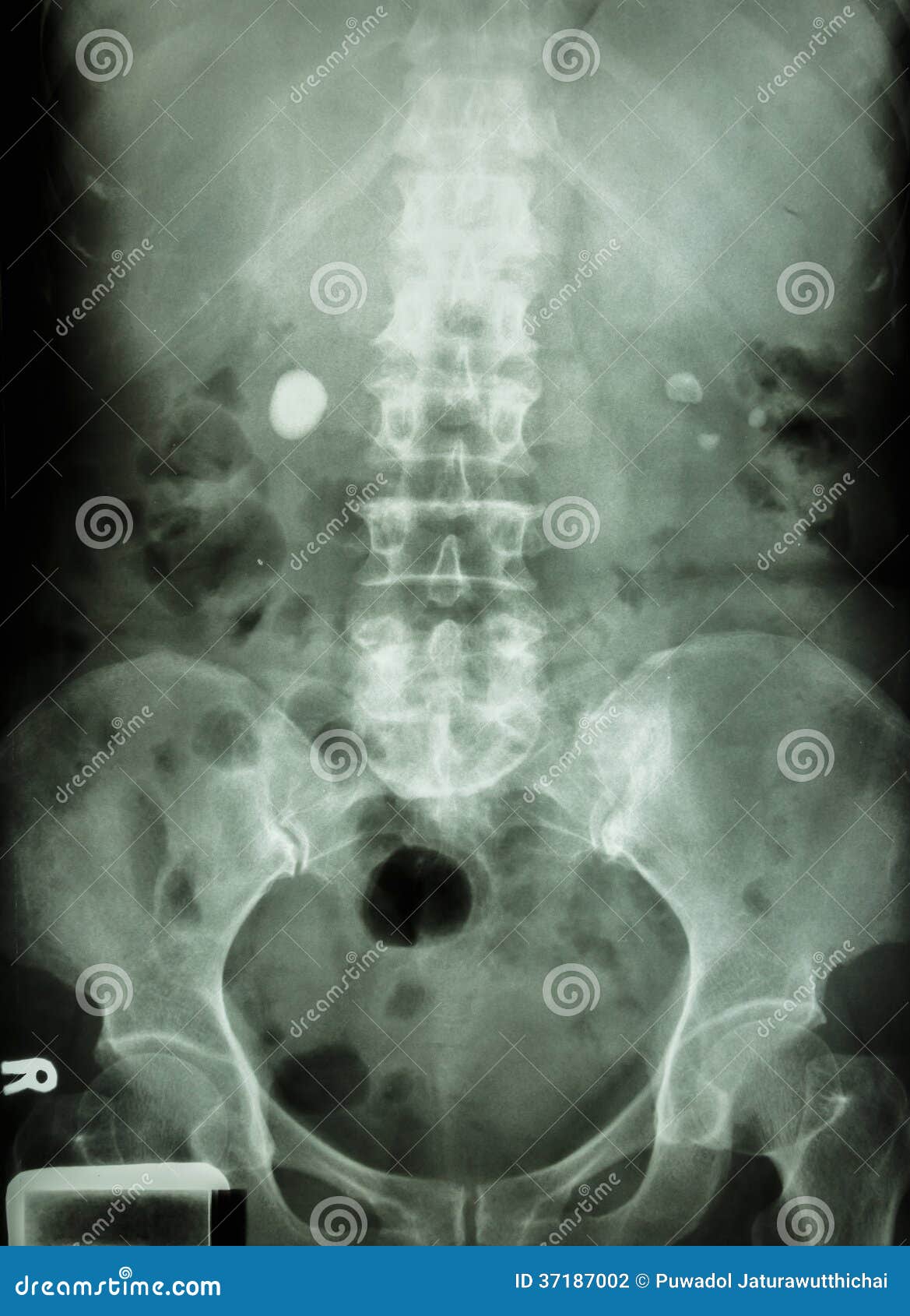 Calcolo renale bilaterale fotografia stock. Immagine di cura - 37187002