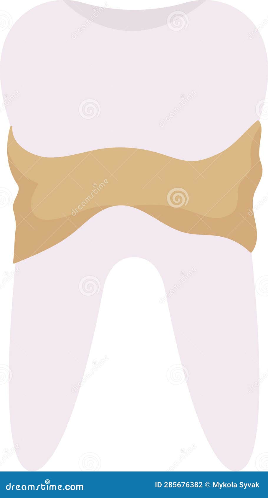 Calculus Tooth Problem stock vector. Illustration of teeth - 285676382