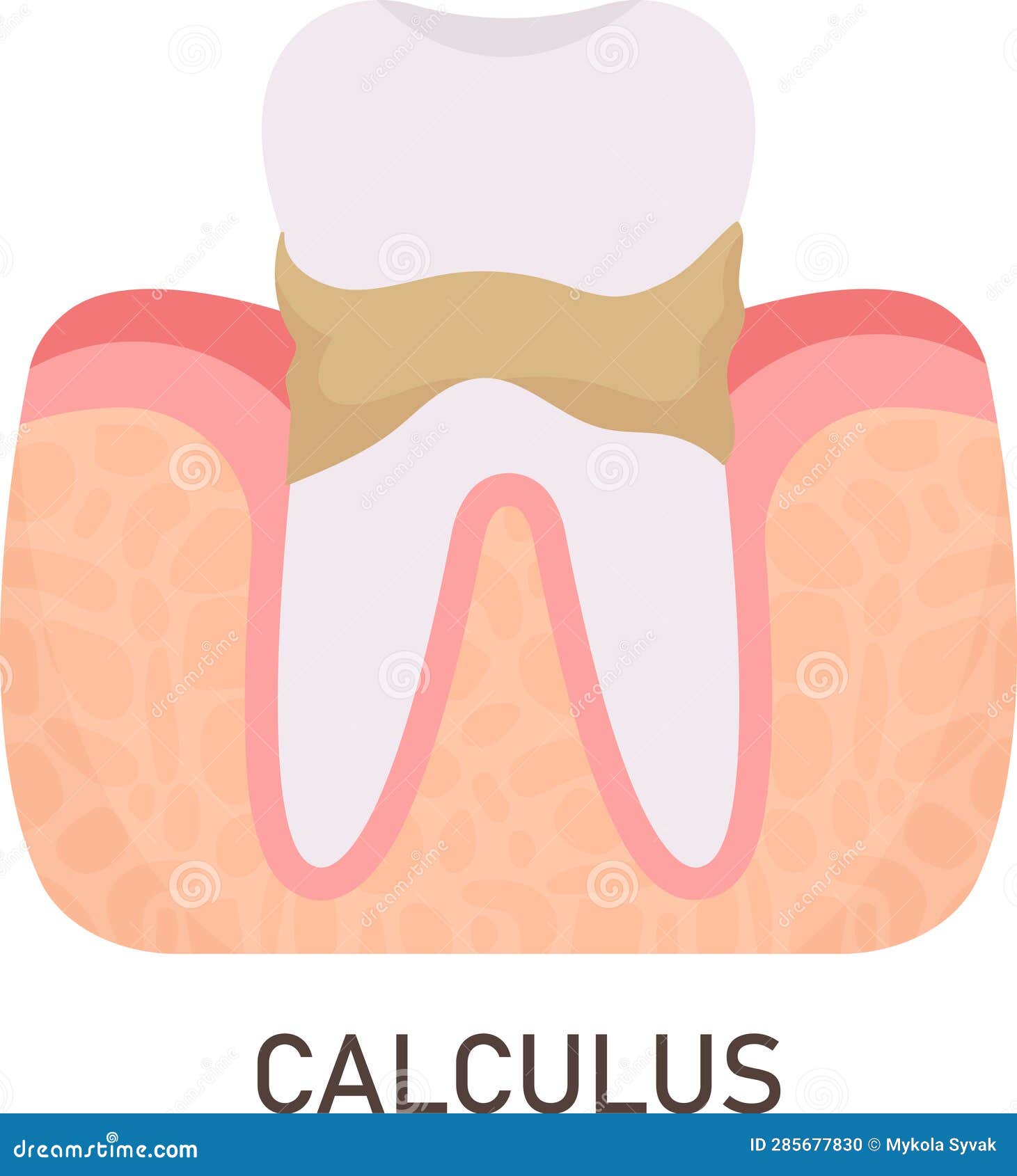 Calculus Tooth Problem stock vector. Illustration of hygiene - 285677830