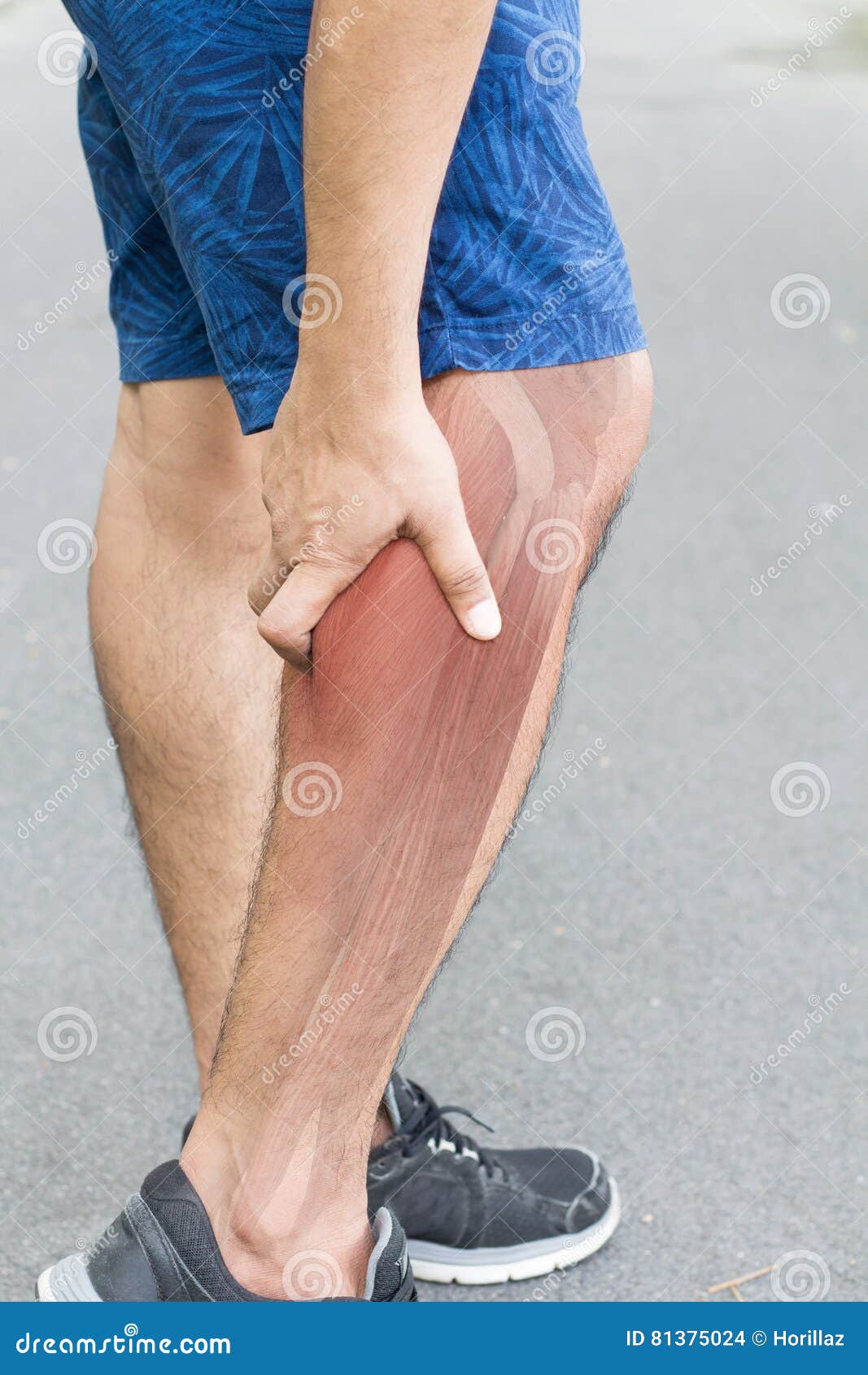 Calf muscle pain stock photo. Image of ache, extensor - 81375024