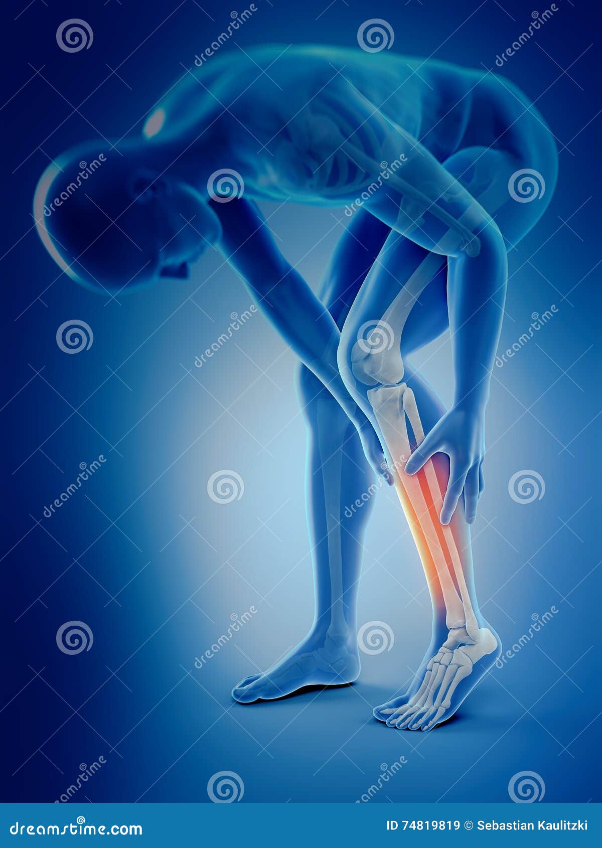Calf Pain Explanation With Cramp From Muscle Contraction Outline ...