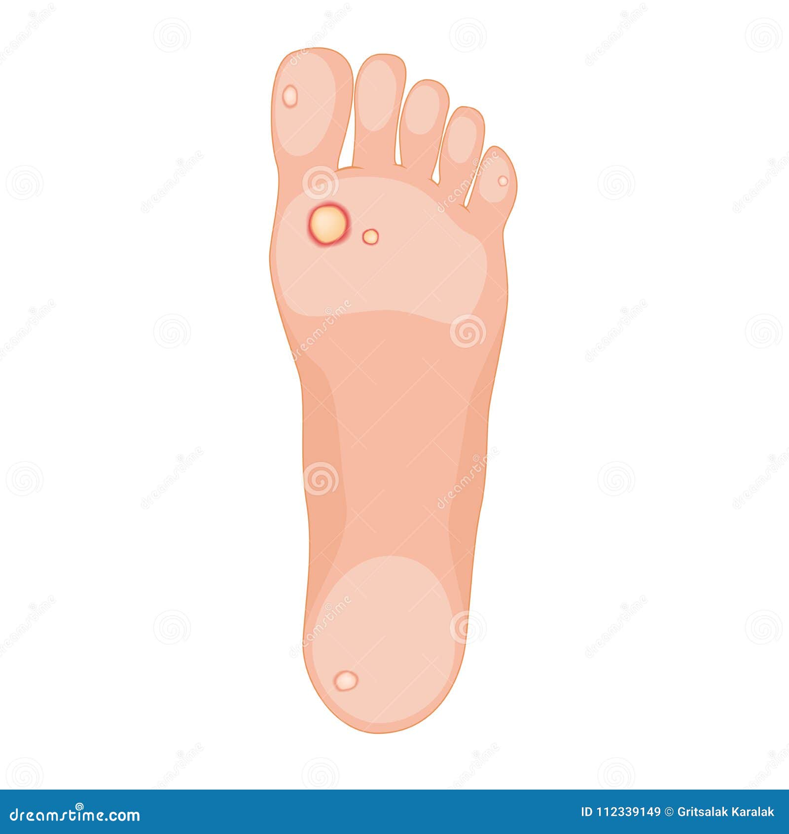 Callo Del Punto De Impacto Del Pie Ilustración del Vector - Ilustración ...