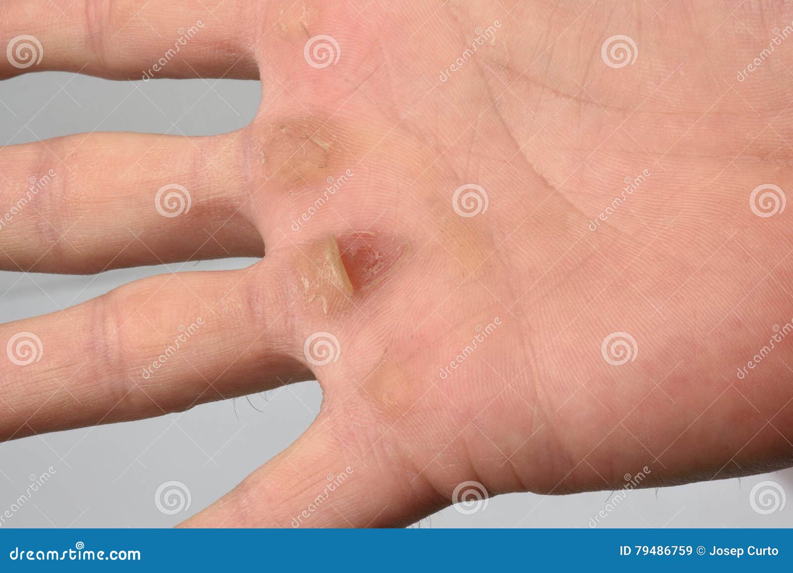 Callos en la palma, imagen de archivo. Imagen de mano - 79486759