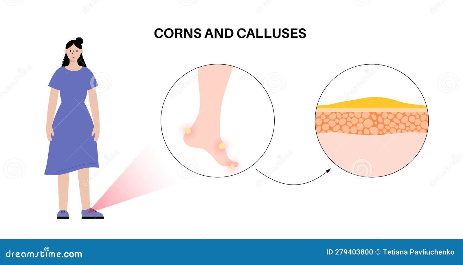 Plantar Hyperhidrosis Poster Vector Illustration | CartoonDealer.com ... Plantar Hyperhidrosis Poster Vector Illustration | CartoonDealer.com ...