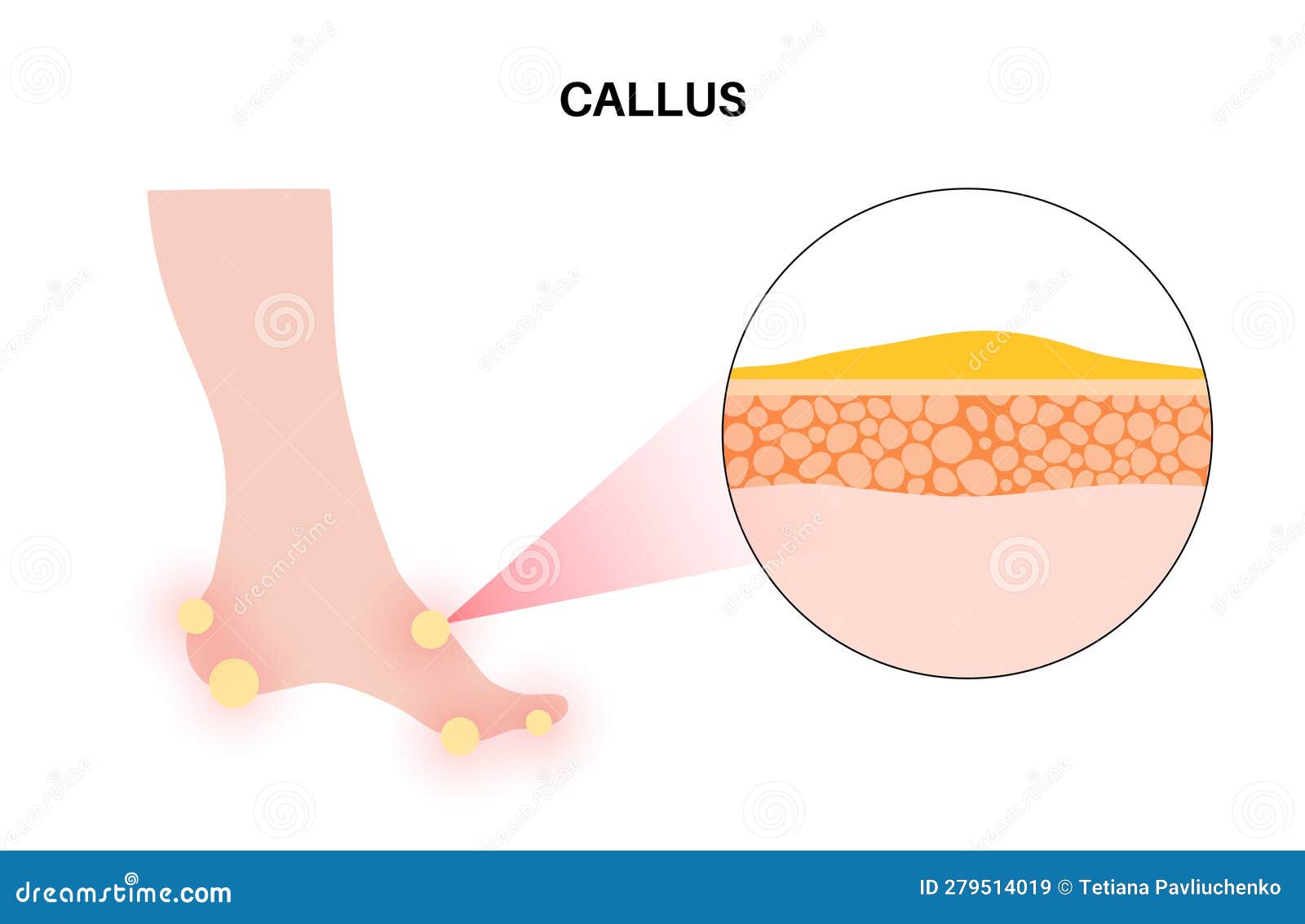 Plantar Hyperhidrosis Poster Vector Illustration | CartoonDealer.com ... Plantar Hyperhidrosis Poster Vector Illustration | CartoonDealer.com ...