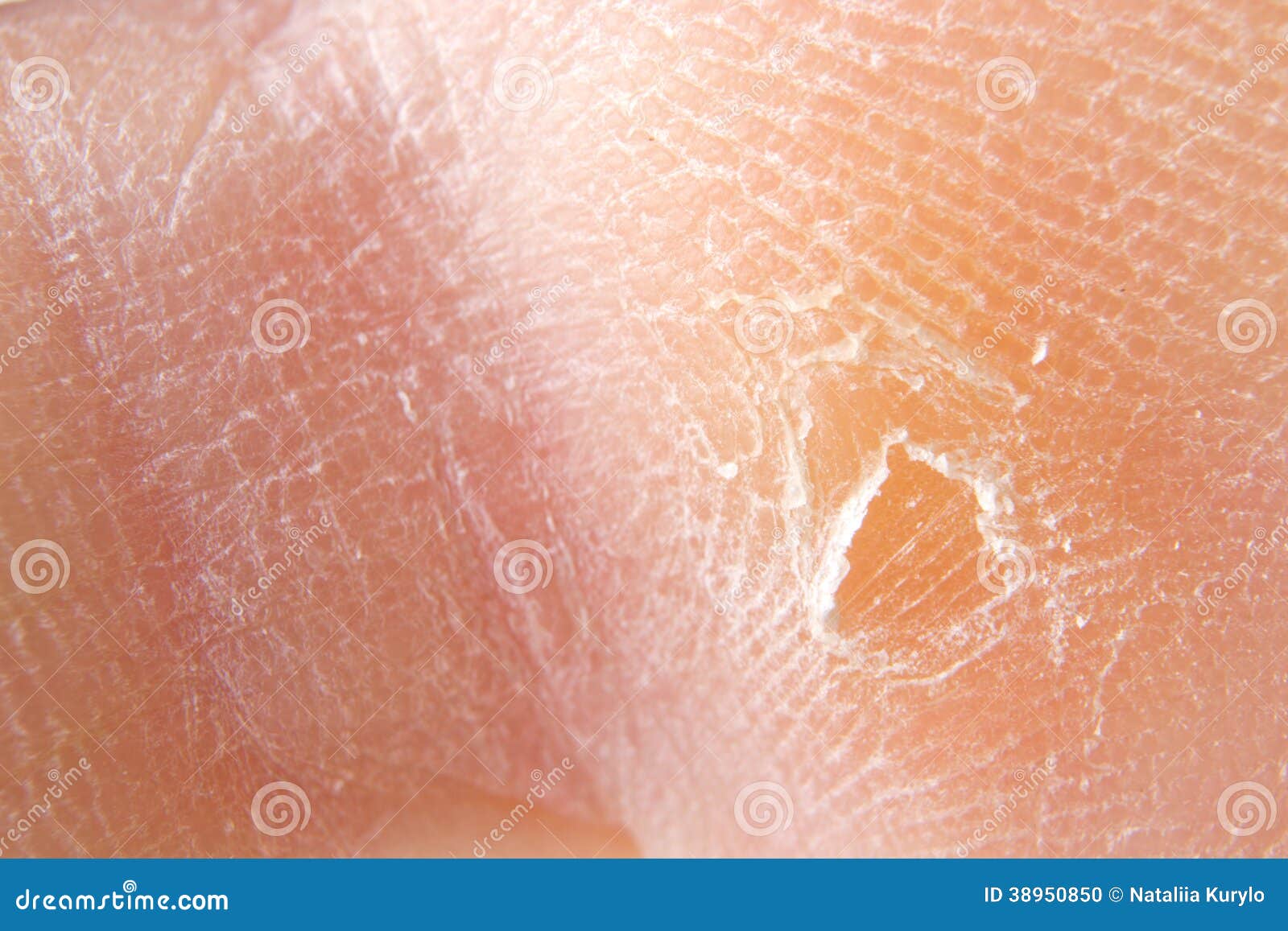 Callus stock photo. Image of medical, callus, problems - 38950850